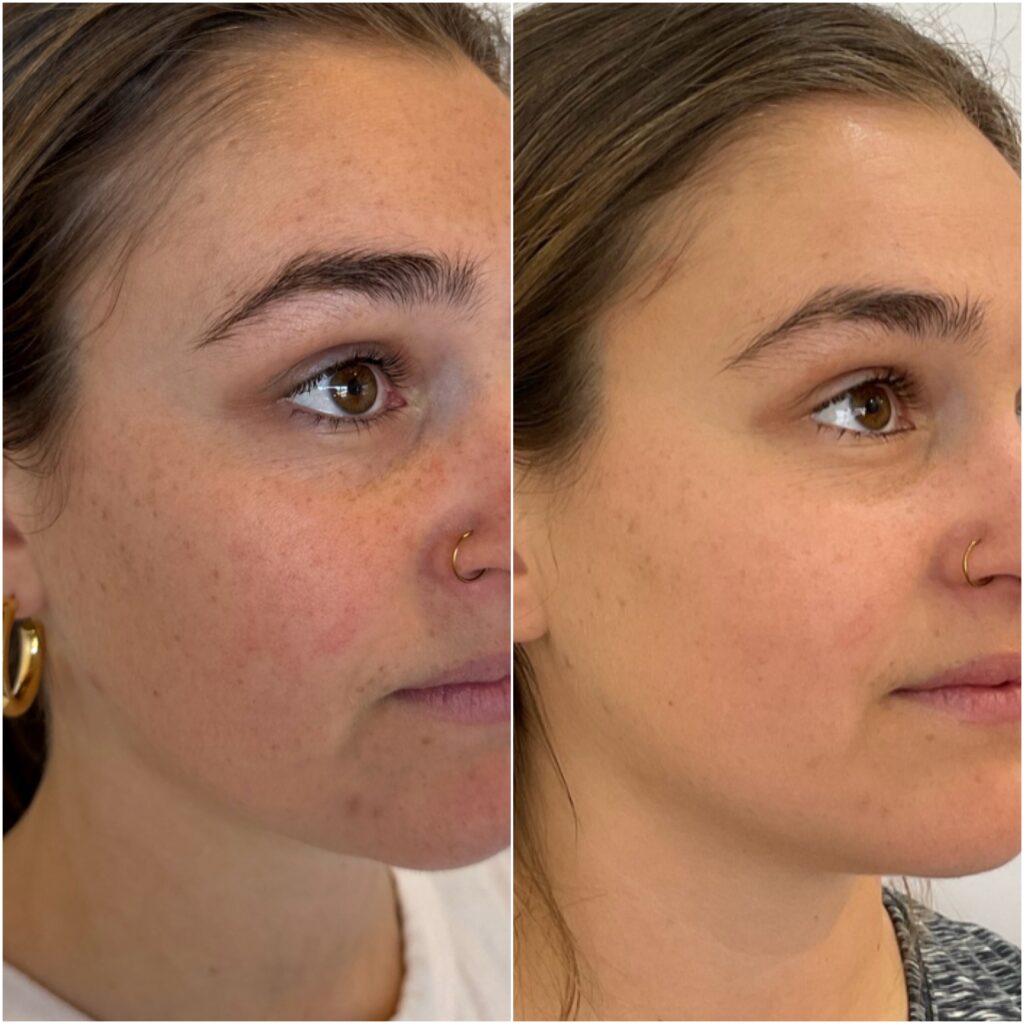 BBL Laser Treatments (Broad Band Light) in Boulder, CO